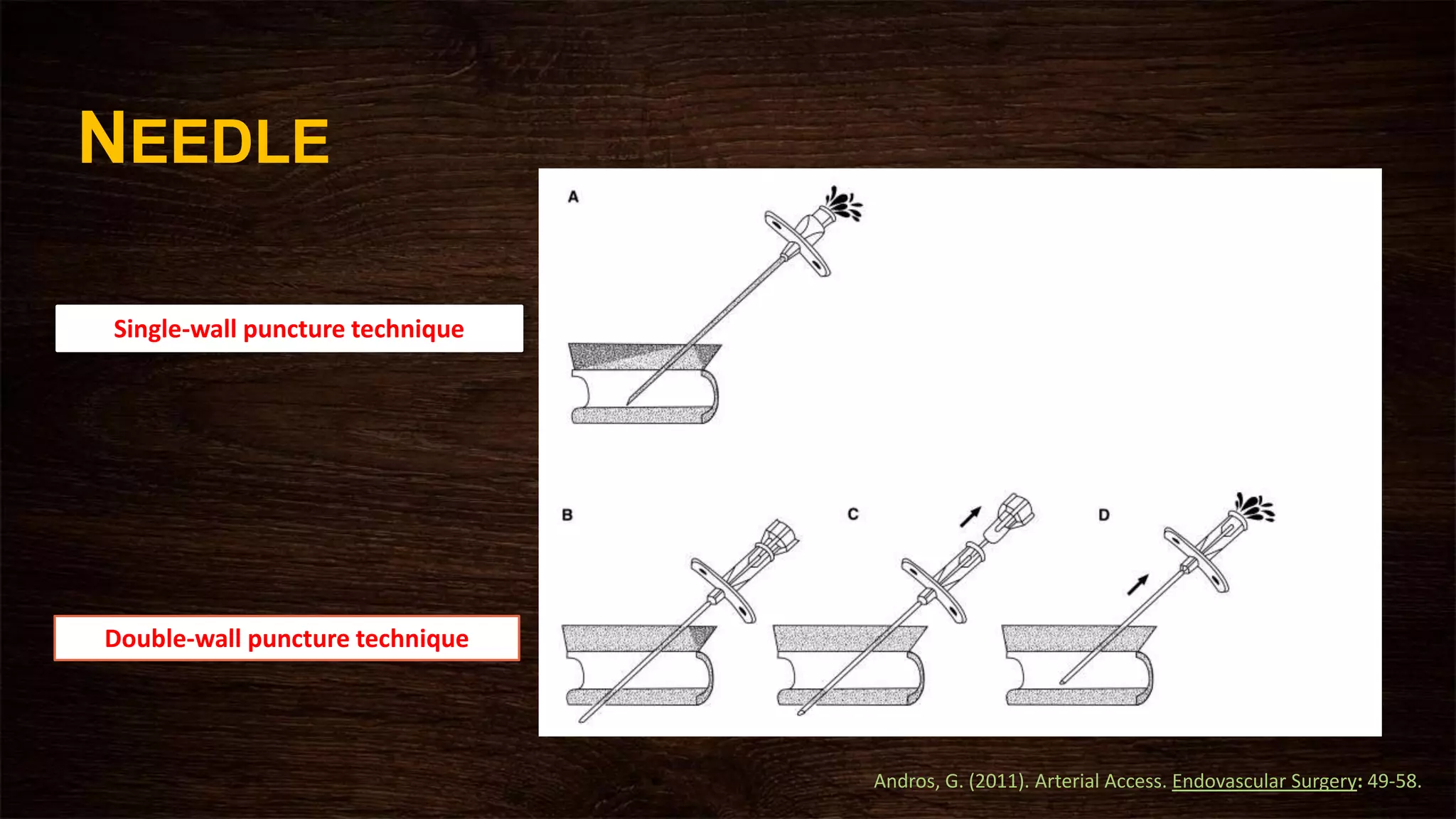 Technique of peripheral angiogram and complication | PPTX