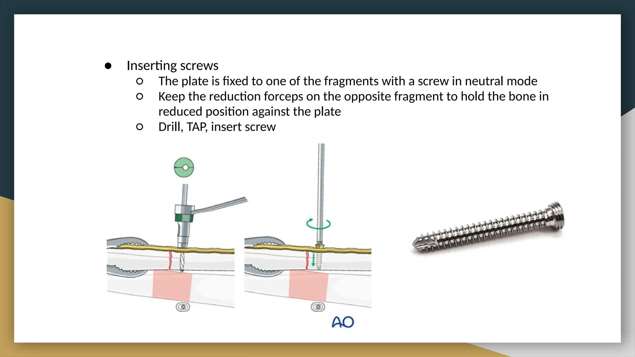 Technique of Plating & Lag screw slide sahre | PPTX