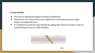 Technique of Plating & Lag screw slide sahre | PPTX