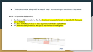Technique of Plating & Lag screw slide sahre | PPTX