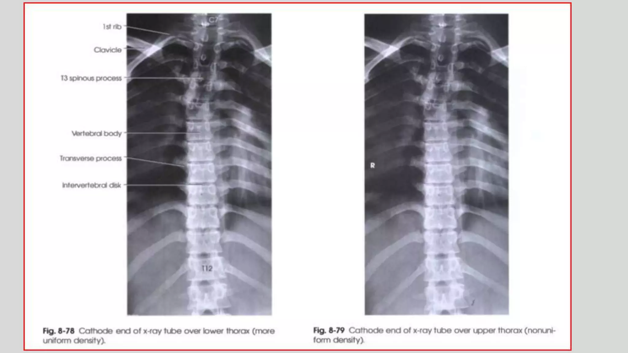 Technique of thoracic and lumber spine radiography | PPTX