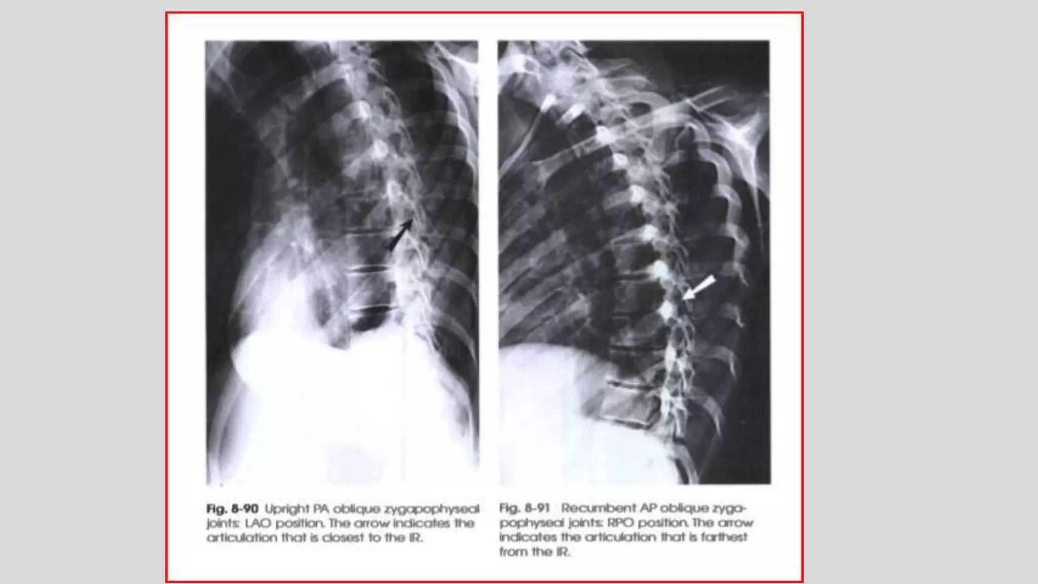 Technique of thoracic and lumber spine radiography | PPTX