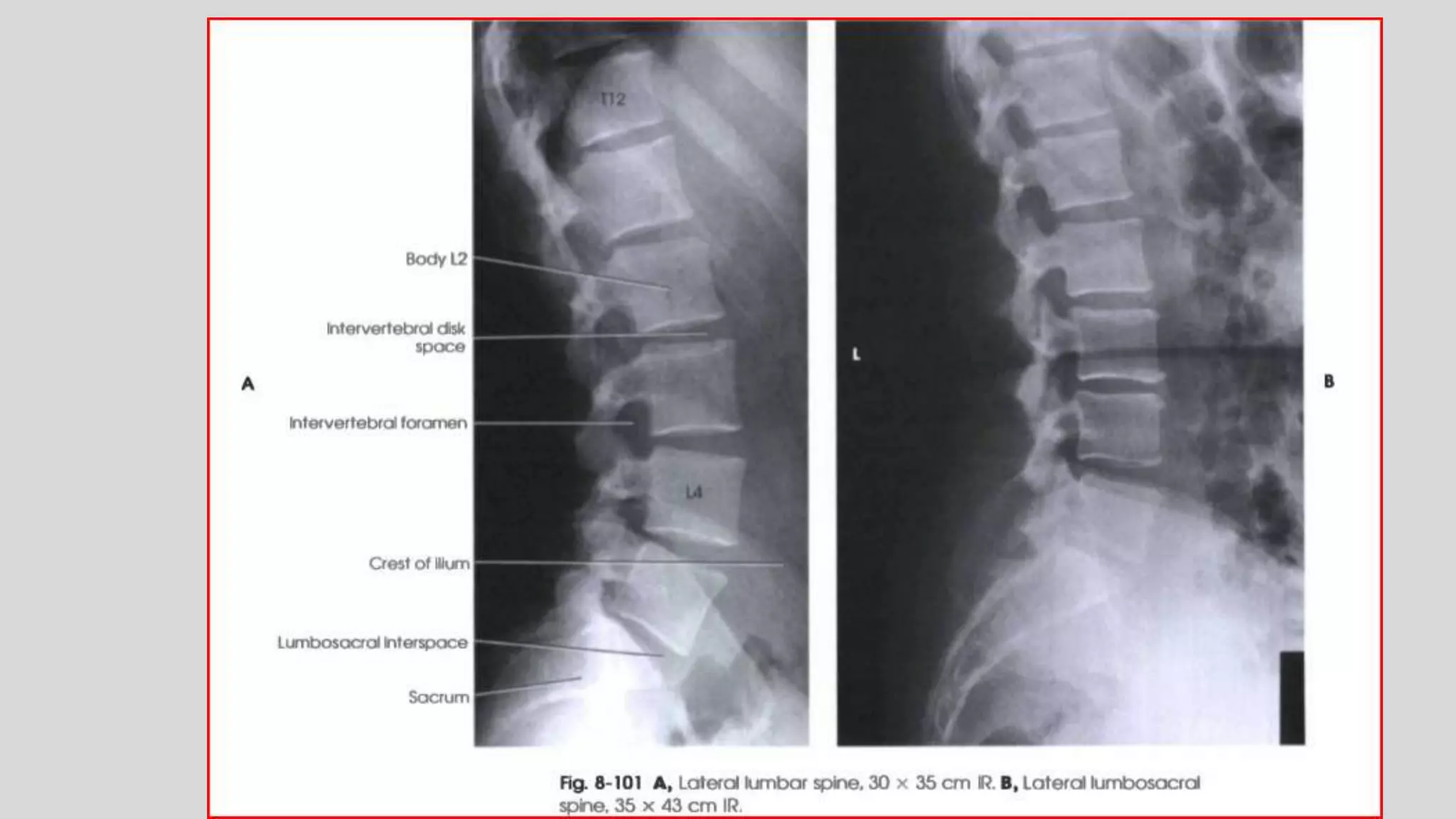 Technique of thoracic and lumber spine radiography | PPTX