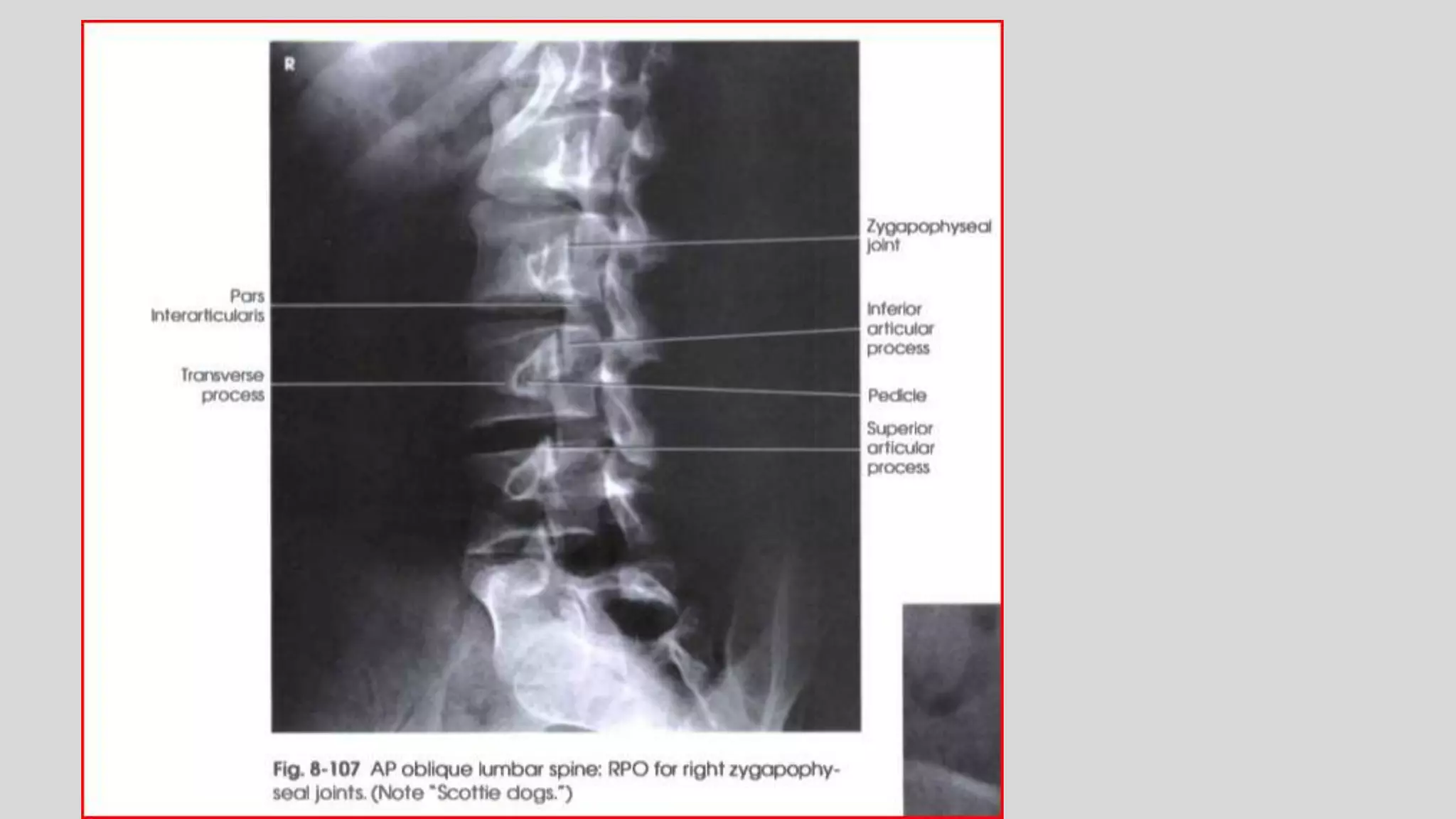 Technique of thoracic and lumber spine radiography | PPTX