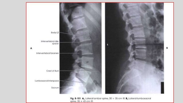 Technique of thoracic and lumber spine radiography | PPTX