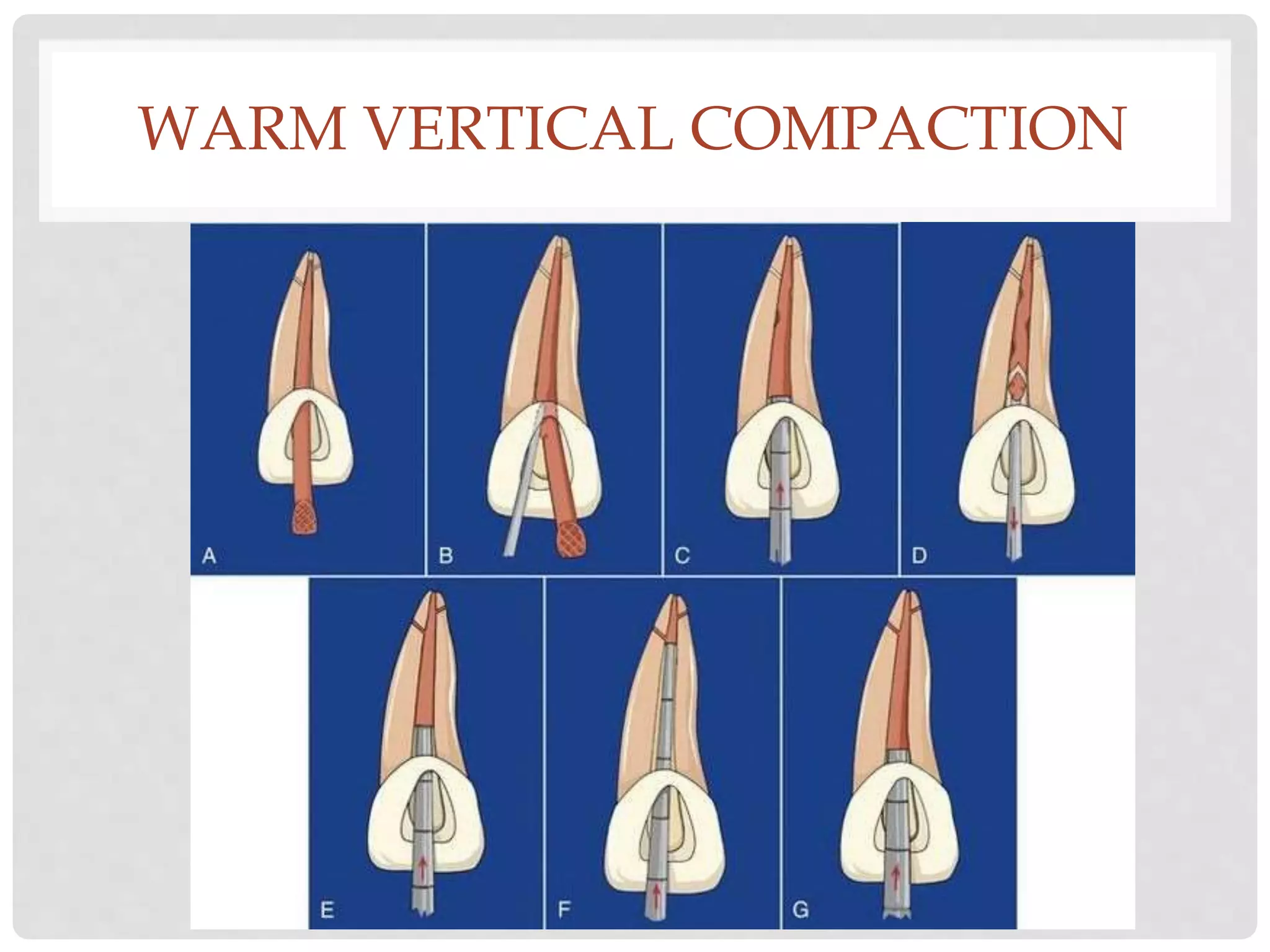 Techniques of Root Canal Obturation | PPTX