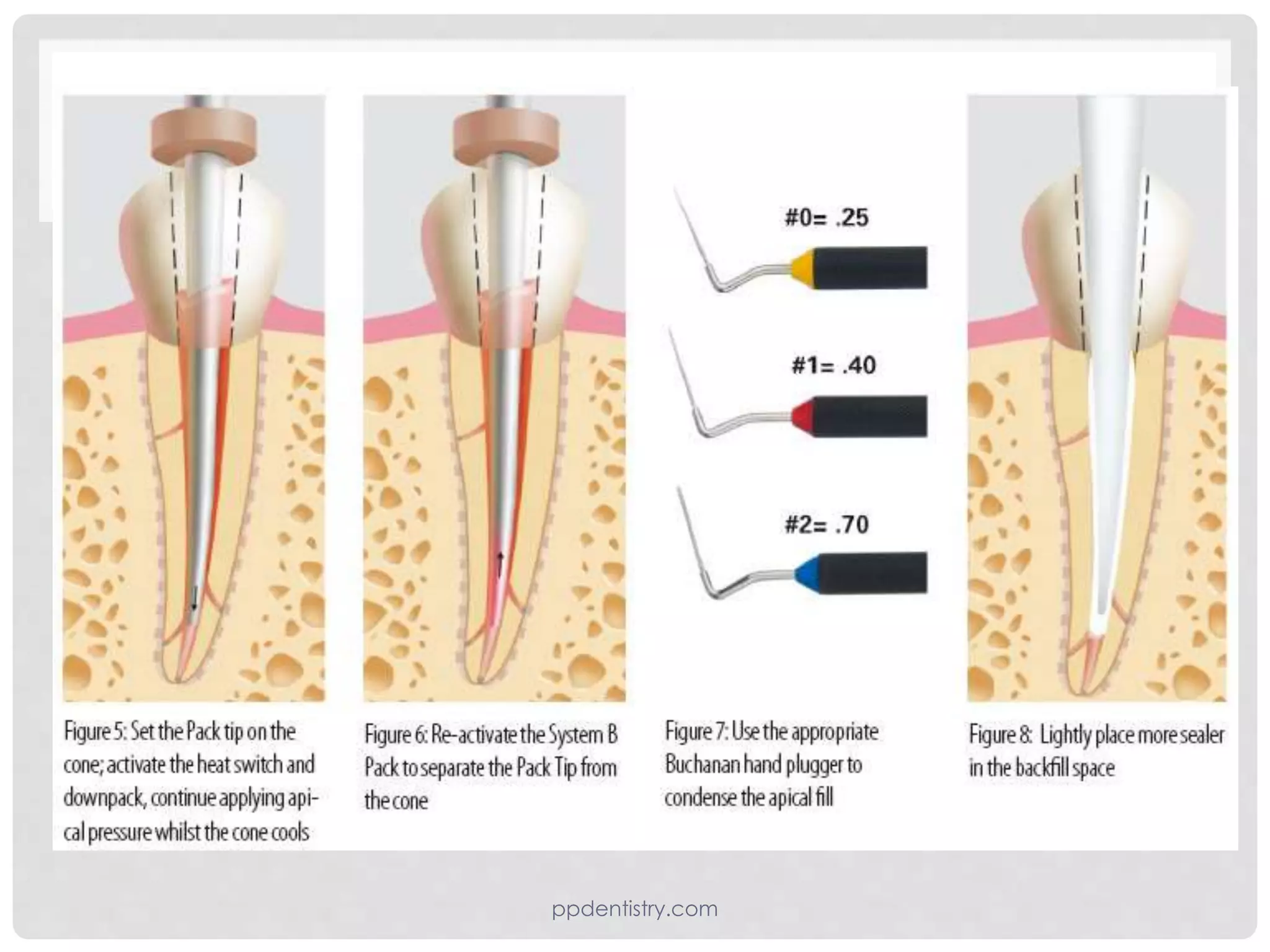Techniques of Root Canal Obturation | PPTX