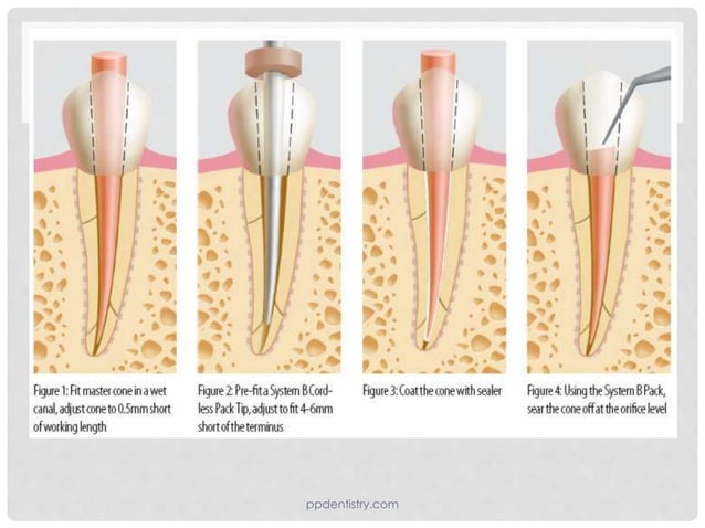 Techniques of Root Canal Obturation | PPTX | Medical Health