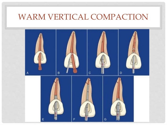 Techniques of Root Canal Obturation