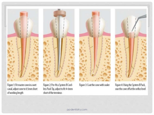 Techniques of Root Canal Obturation