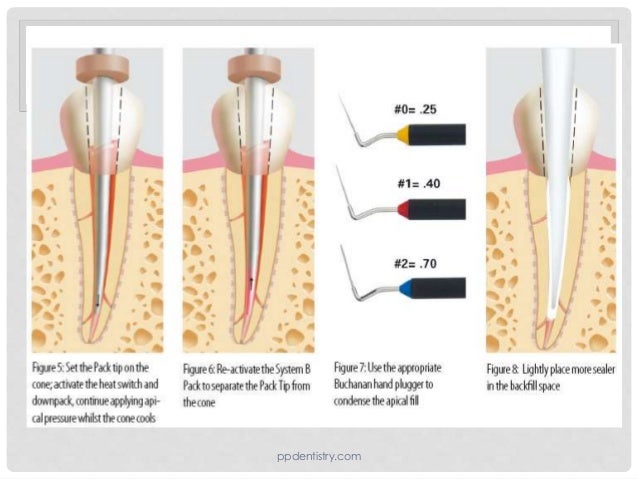 Techniques of Root Canal Obturation
