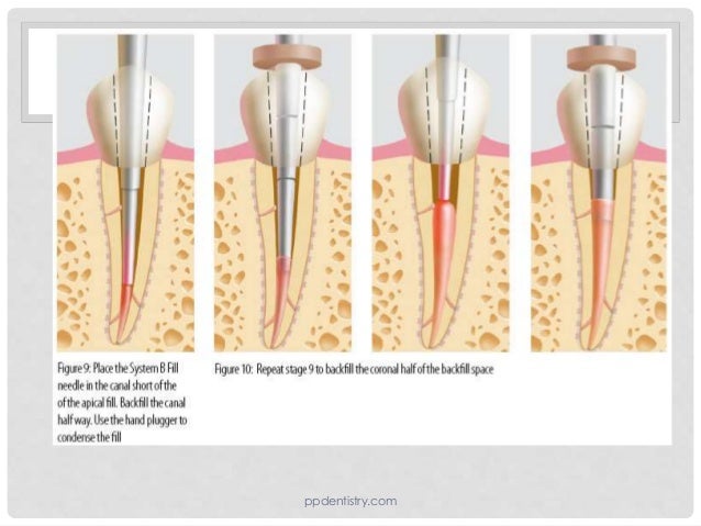 Techniques of Root Canal Obturation