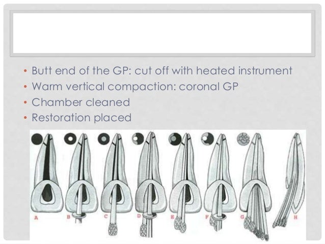 Techniques of Root Canal Obturation