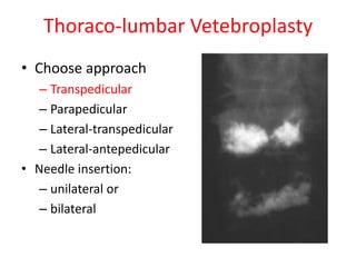 Vertebroplasty and Kyphoplasty Techniques | PPTX