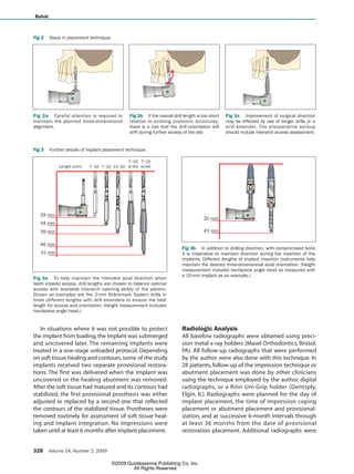 Technique for Placement of Oxidized Titanium Implants by Oded Bahat ...