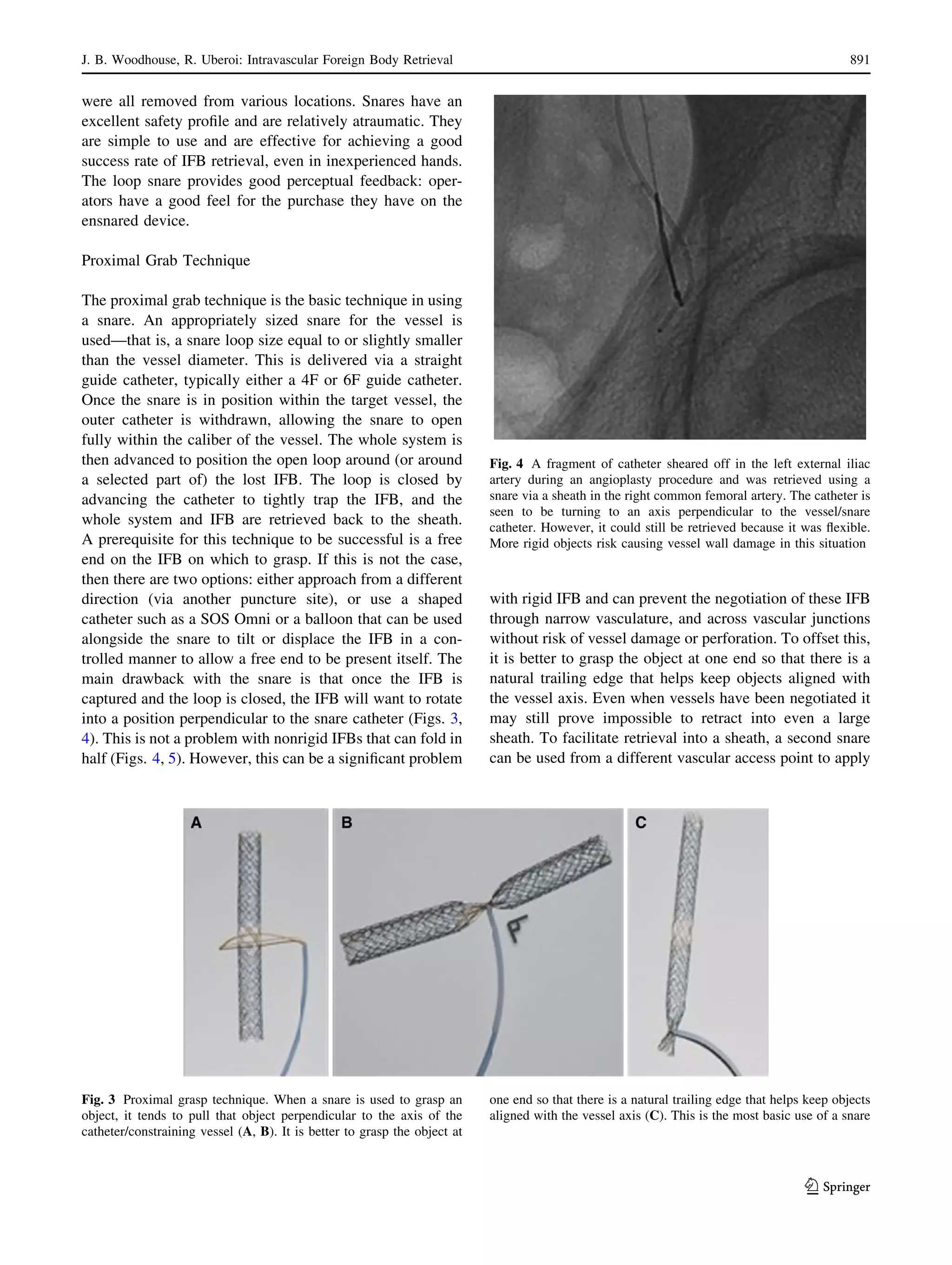 Techniques for intravascular foreign body retrieval | PDF