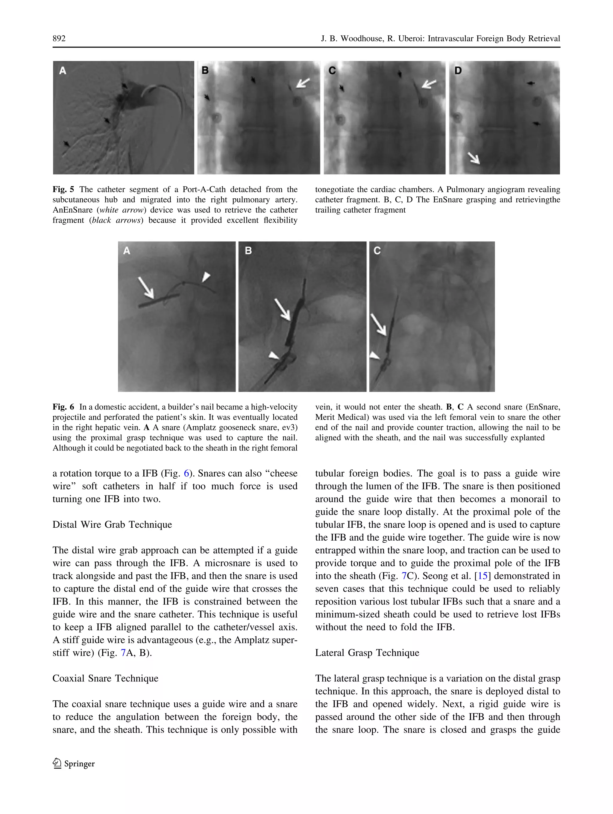 Techniques for intravascular foreign body retrieval | PDF