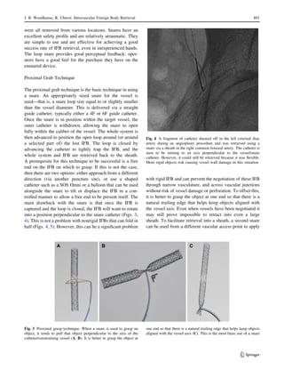Techniques for intravascular foreign body retrieval | PDF