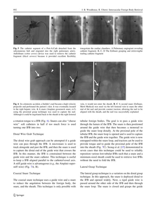 Techniques for intravascular foreign body retrieval | PDF