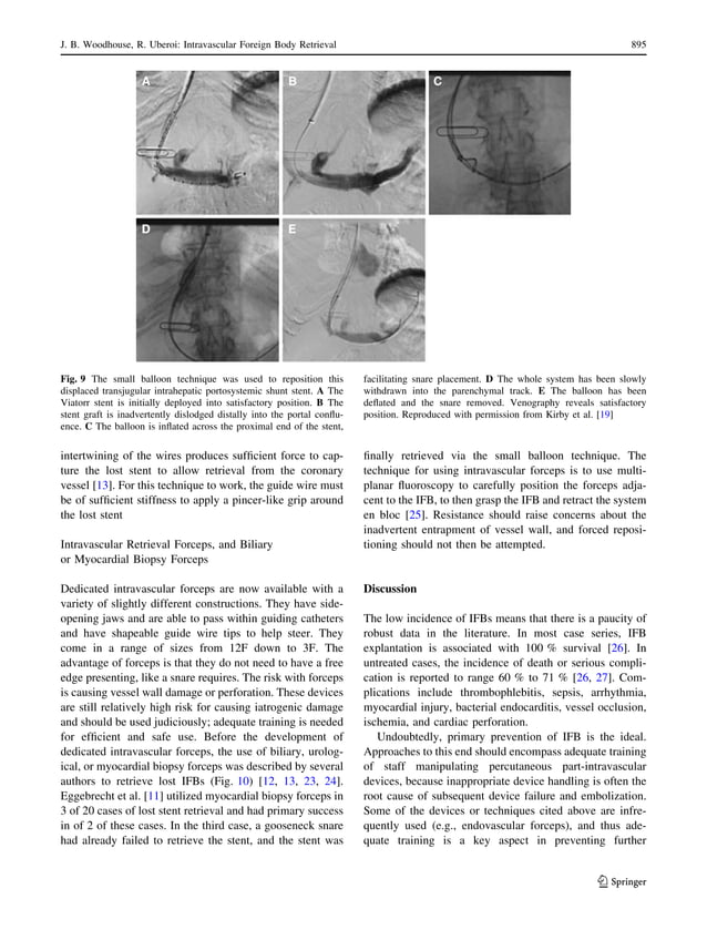 Techniques for intravascular foreign body retrieval | PDF