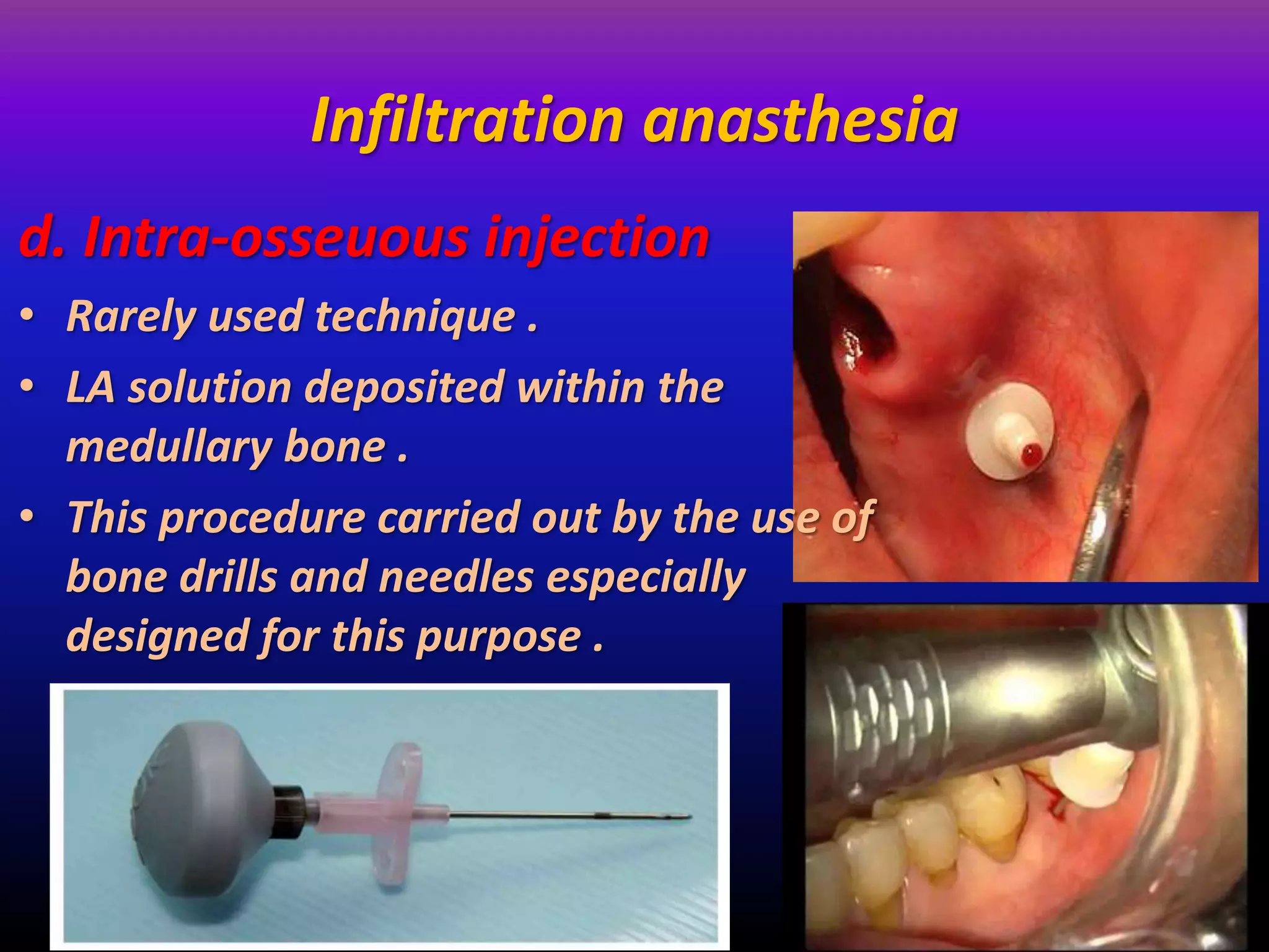 Techniques for local anasthesia in dentistry | PPSX