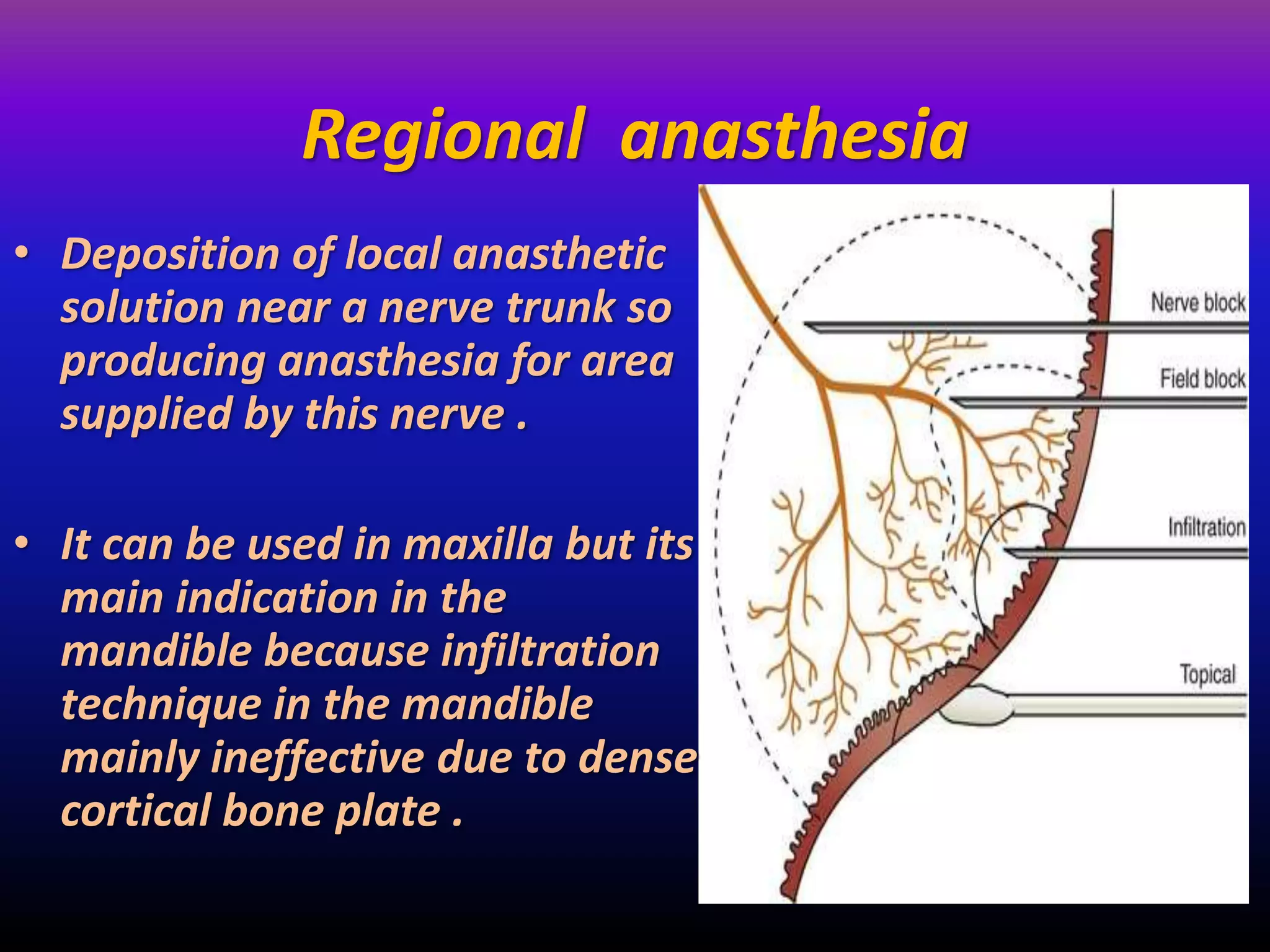 Techniques for local anasthesia in dentistry | PPSX