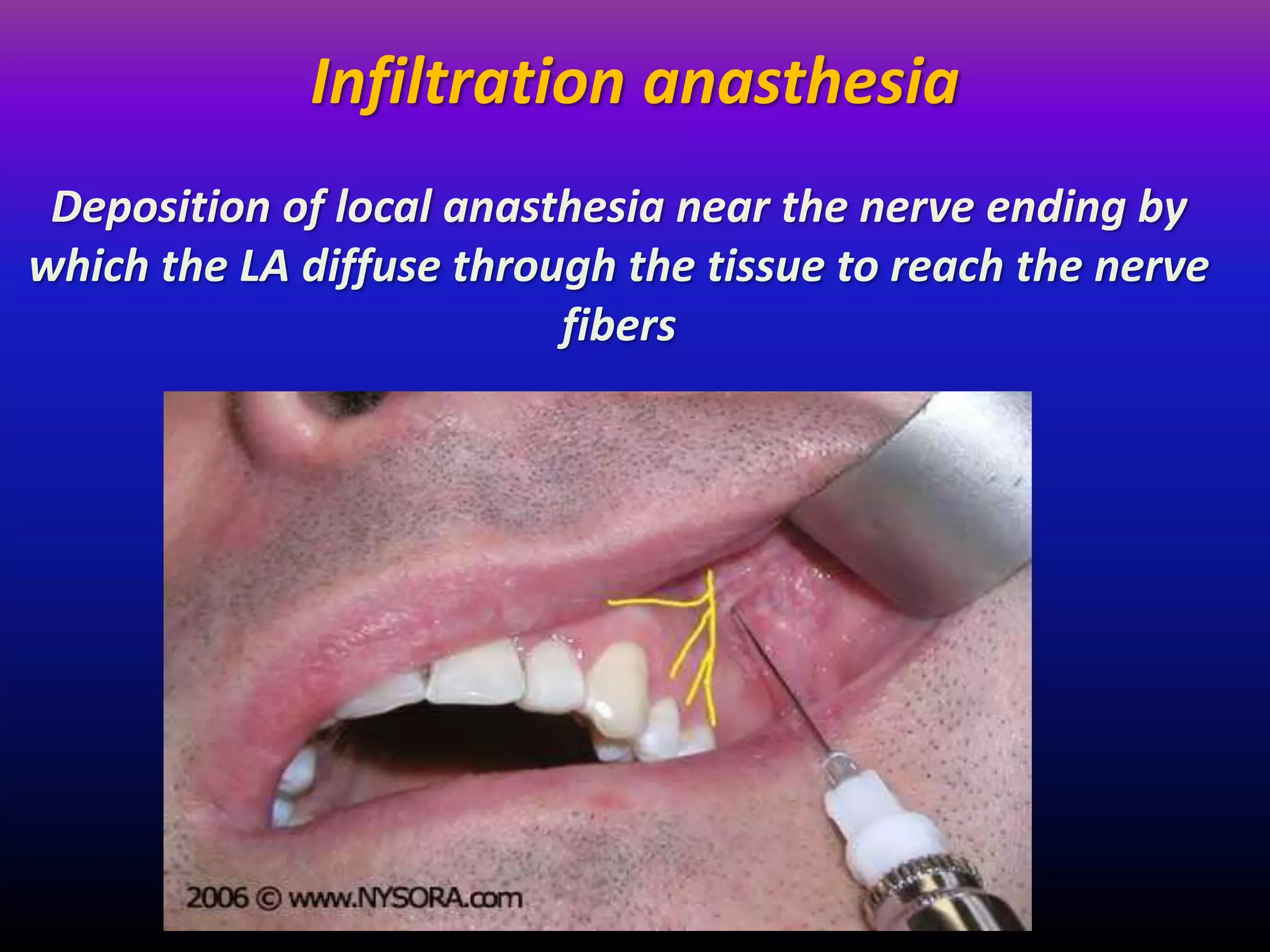 Techniques for local anasthesia in dentistry | PPSX