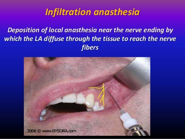 Techniques for local anasthesia in dentistry