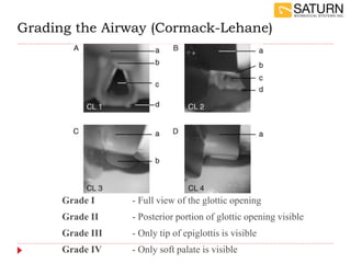 Techniques for the Difficult Airway | PPT