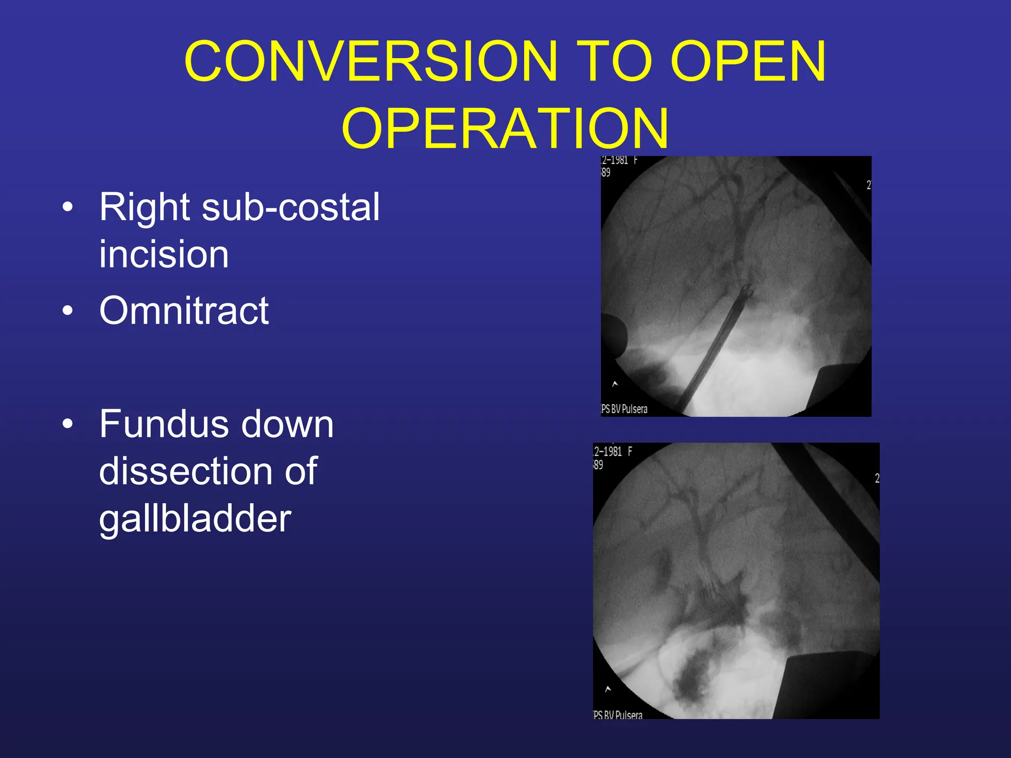 TECHNIQUES FOR THE DIFFICULT GALLBLADDER.pdf