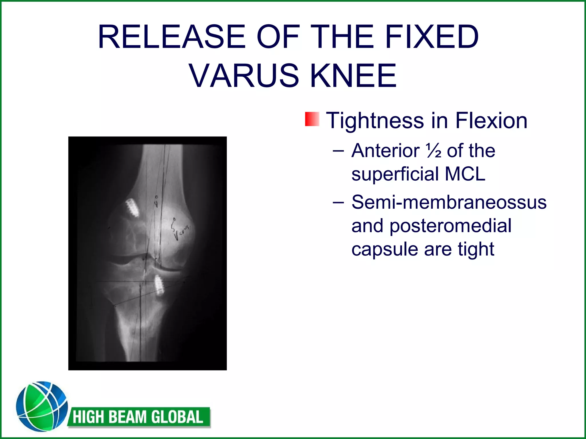 Techniques in primary total knee arthroplasty | PPT