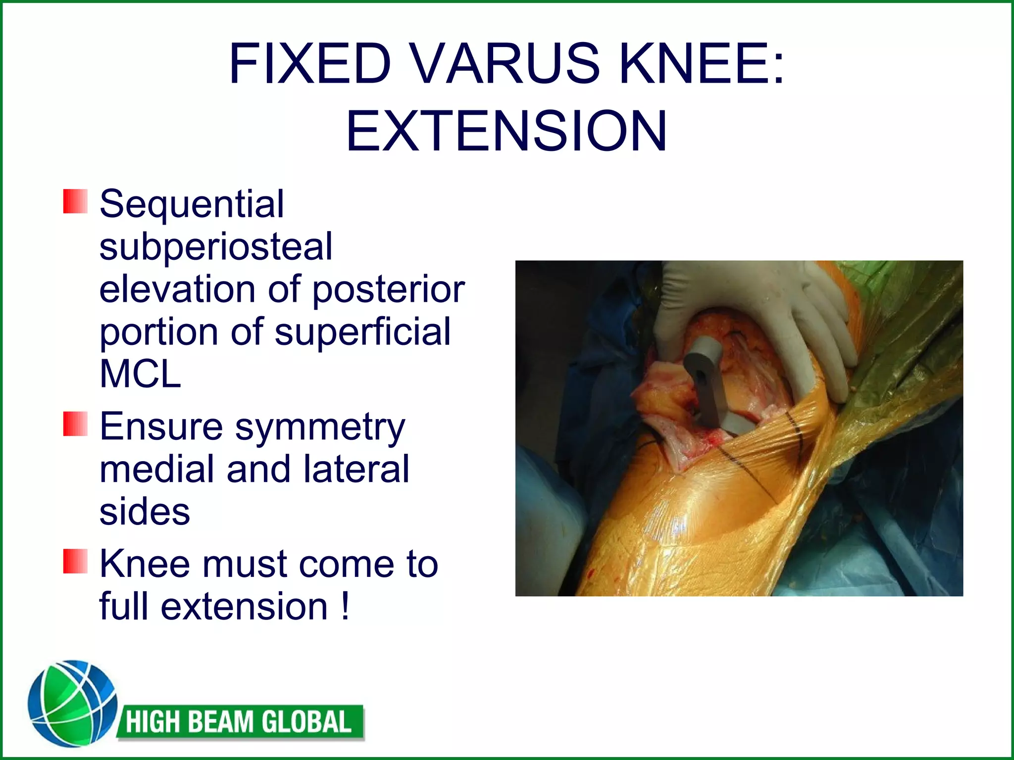 Techniques in primary total knee arthroplasty | PPT