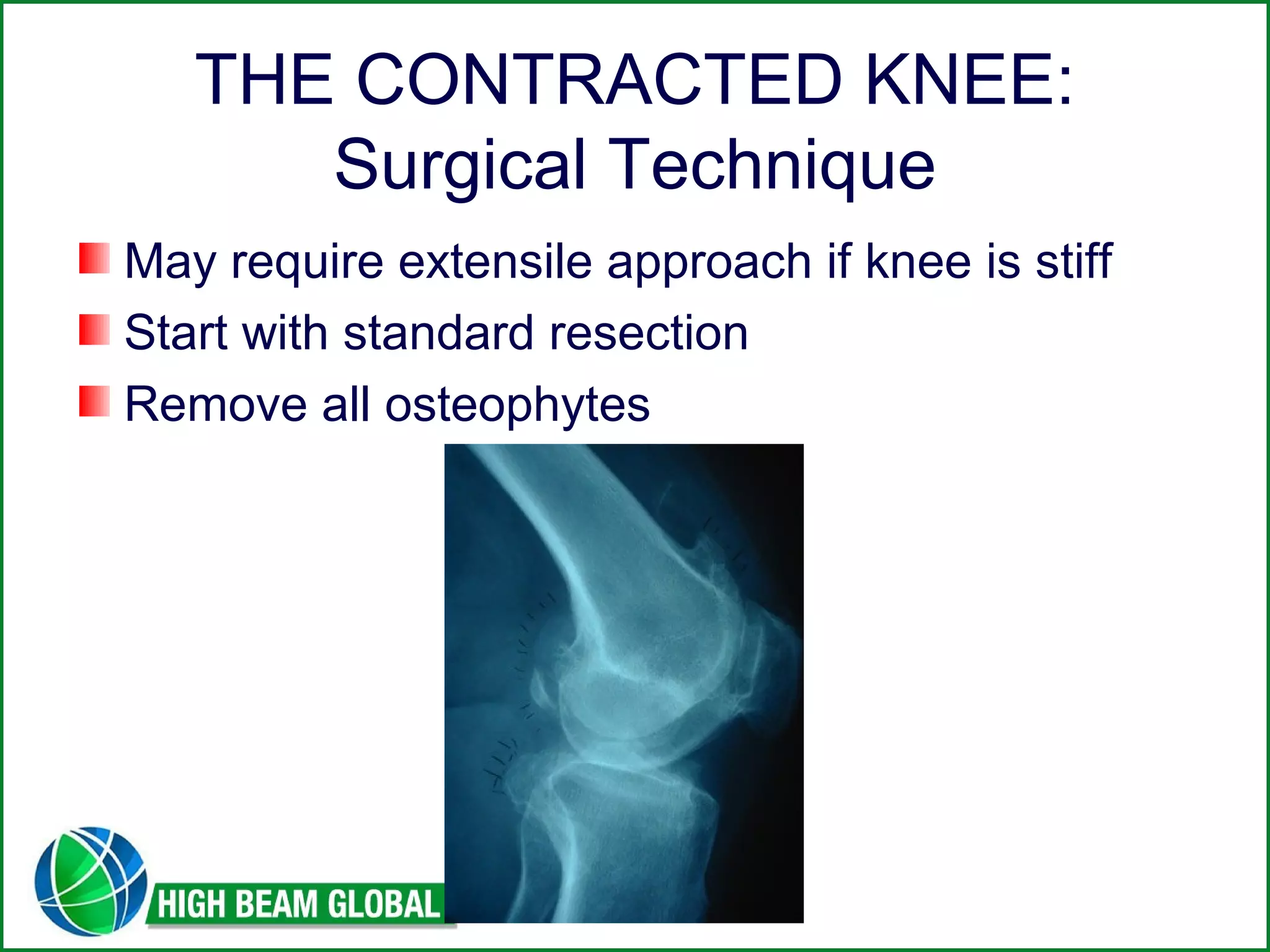 Techniques in primary total knee arthroplasty | PPT