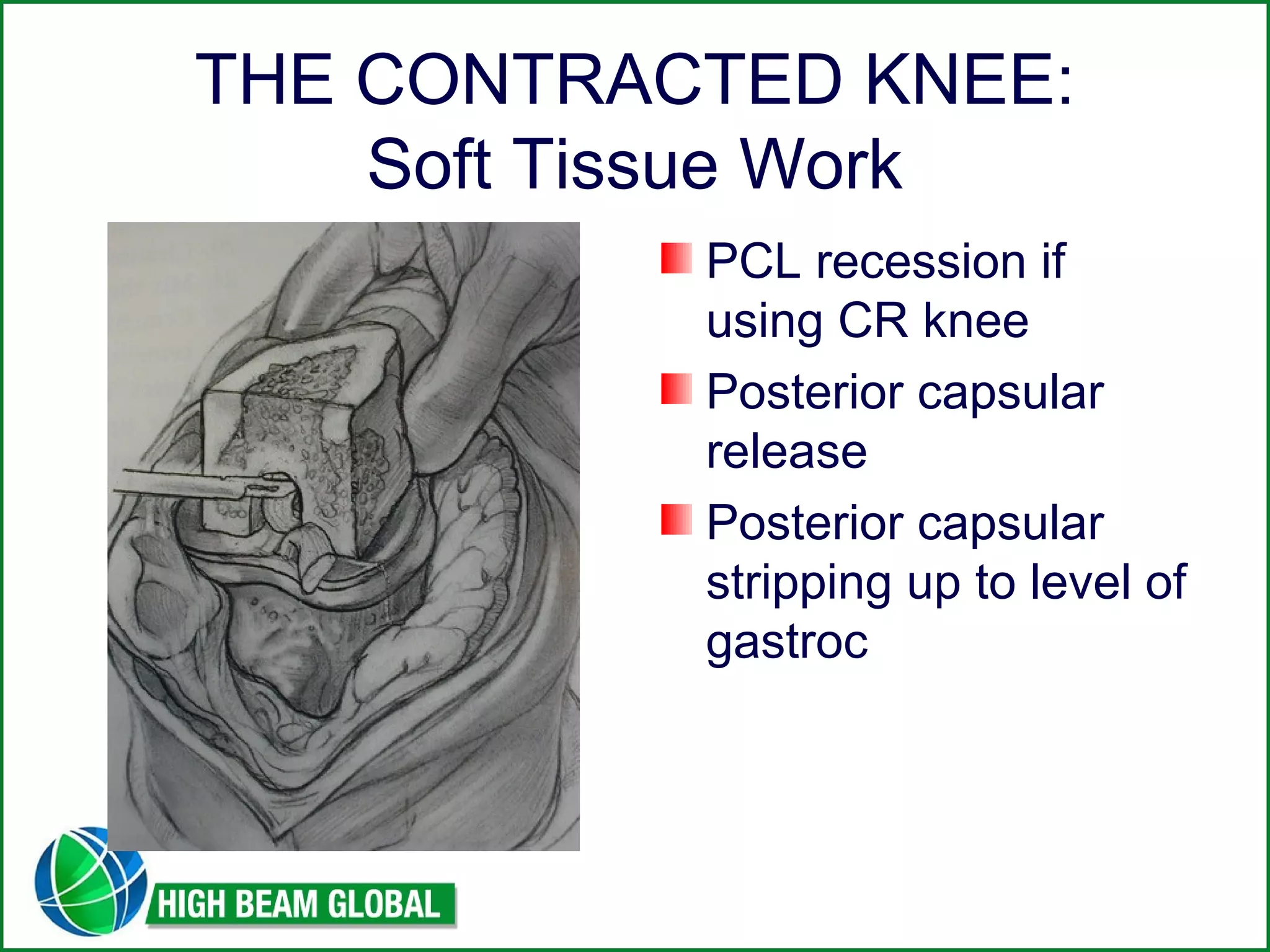Techniques in primary total knee arthroplasty | PPT