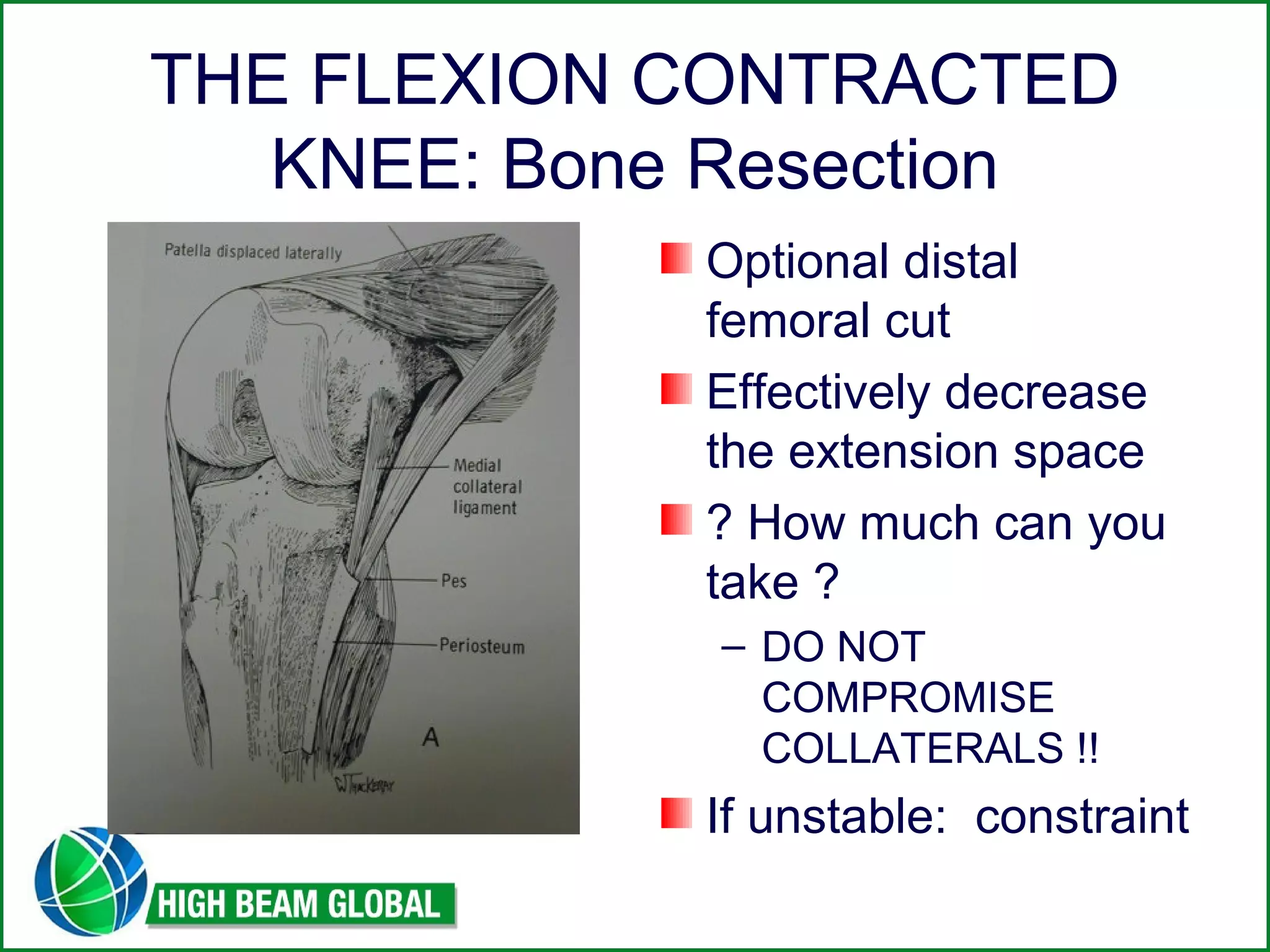 Techniques in primary total knee arthroplasty | PPT