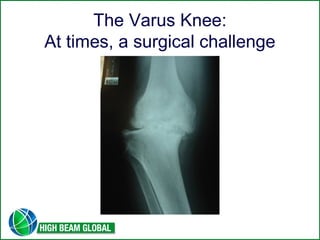 Techniques in primary total knee arthroplasty | PPT