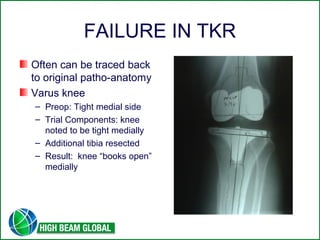 Techniques in primary total knee arthroplasty | PPT