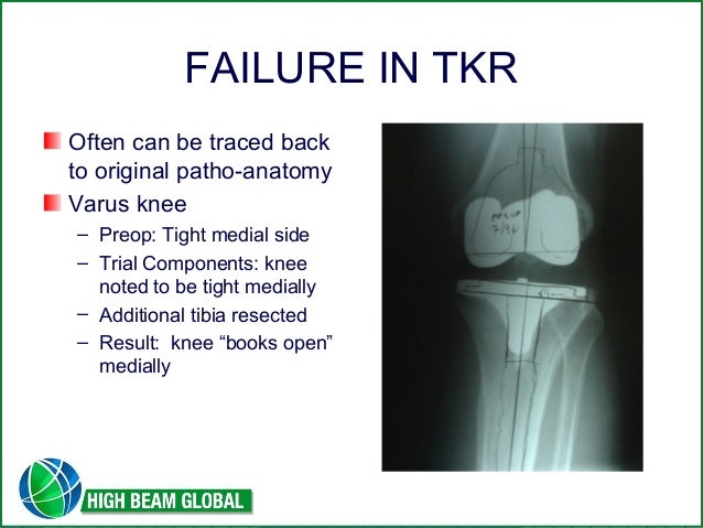 Techniques in primary total knee arthroplasty