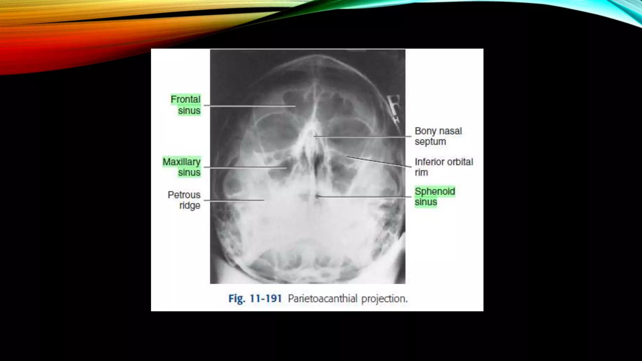 X ray of technique sinuses | PPT