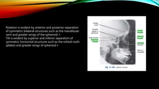 X ray of technique sinuses | PPT