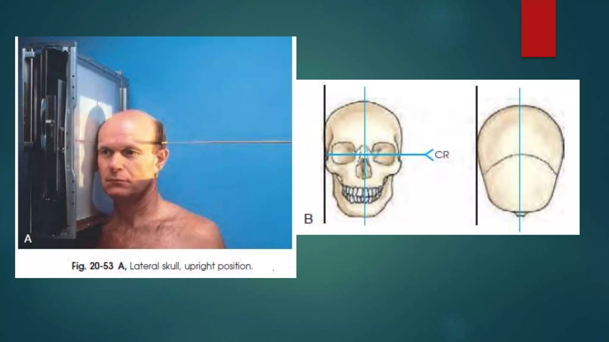 Technique skull x ray | PPTX
