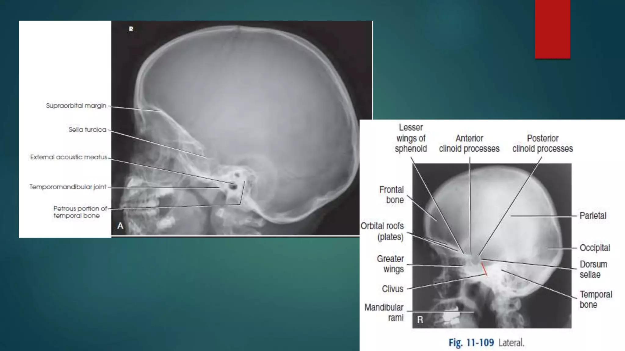 Technique skull x ray | PPTX