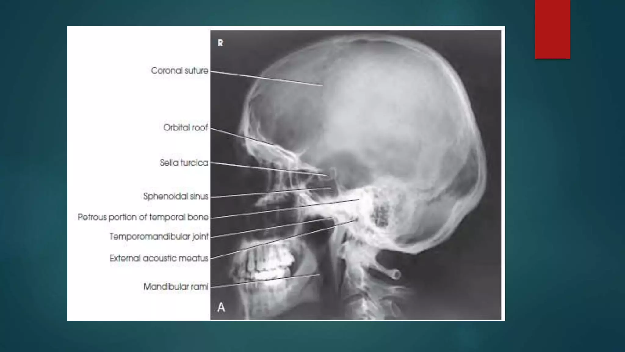 Technique skull x ray | PPTX