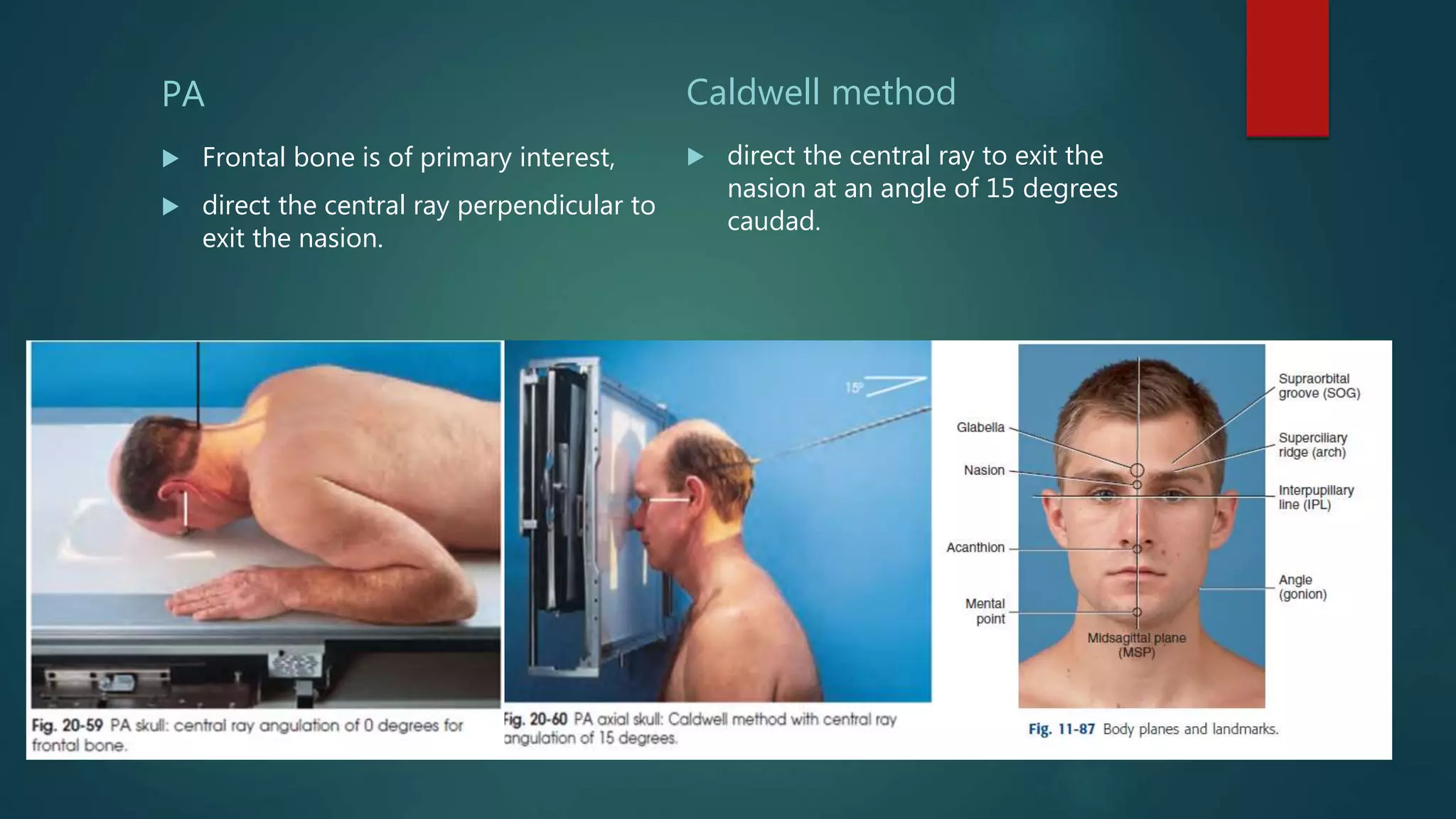 Technique skull x ray | PPTX