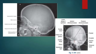 Technique skull x ray | PPTX