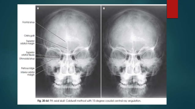 Technique skull x ray | PPTX