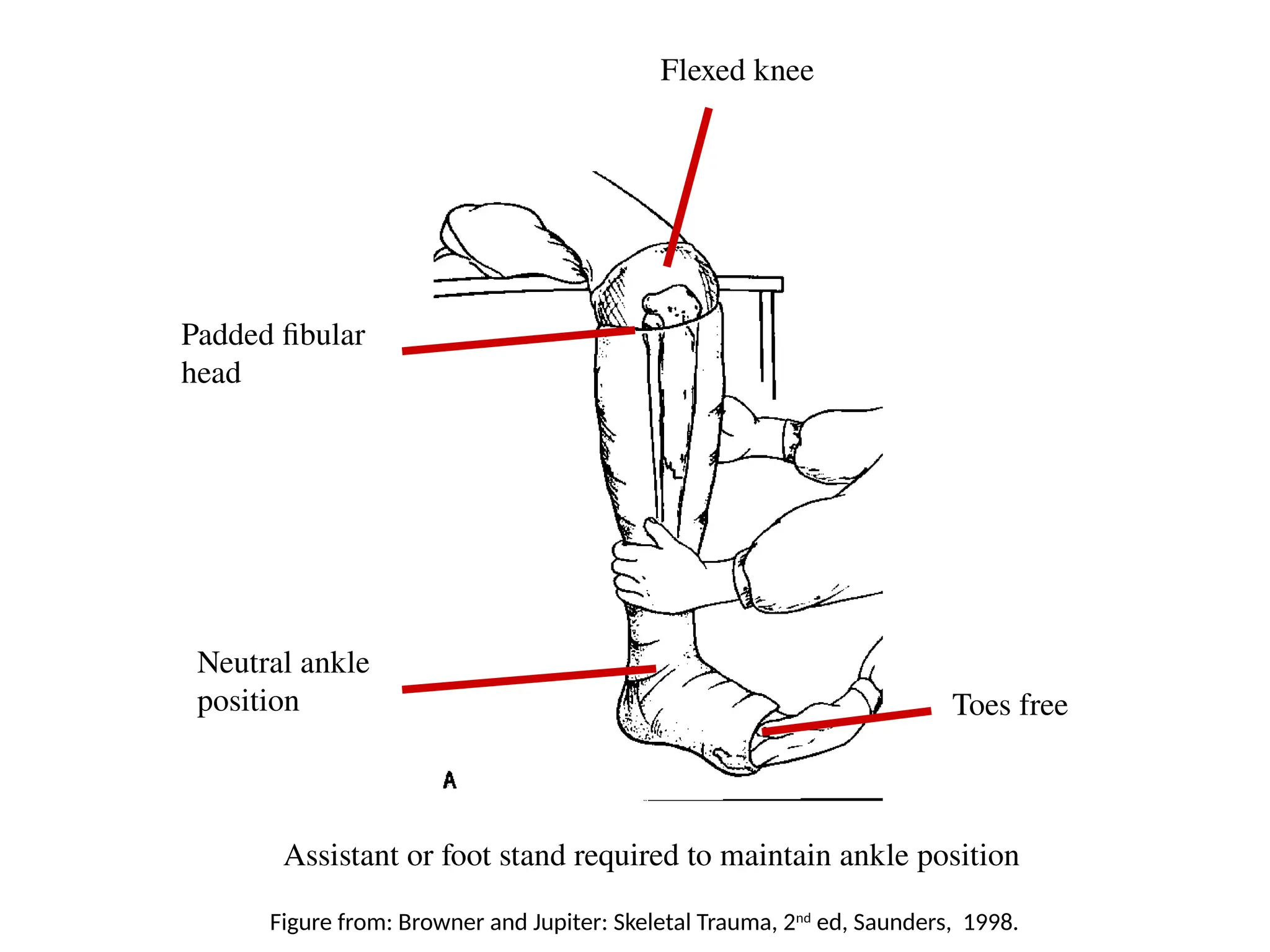 techniques of cast application and cast complications.pptx