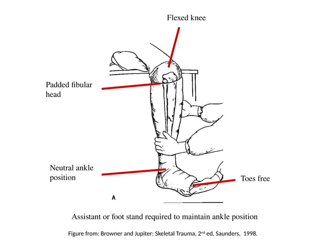 techniques of cast application and cast complications.pptx