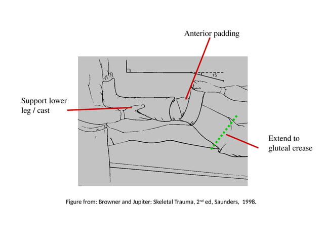 techniques of cast application and cast complications.pptx
