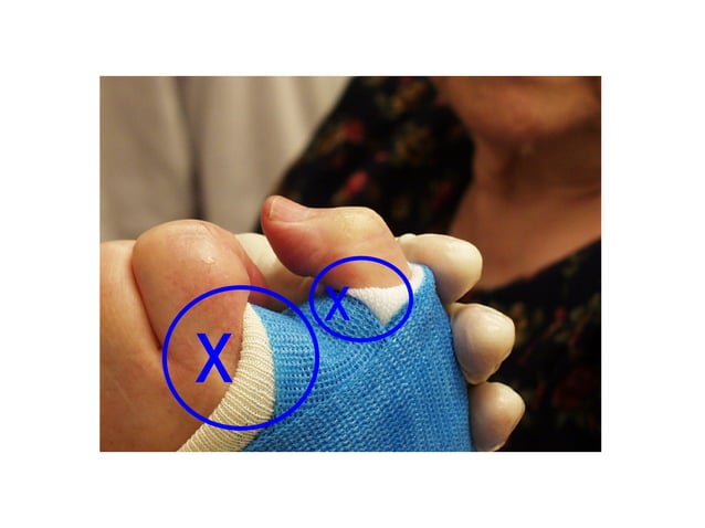 techniques of cast application and cast complications.pptx